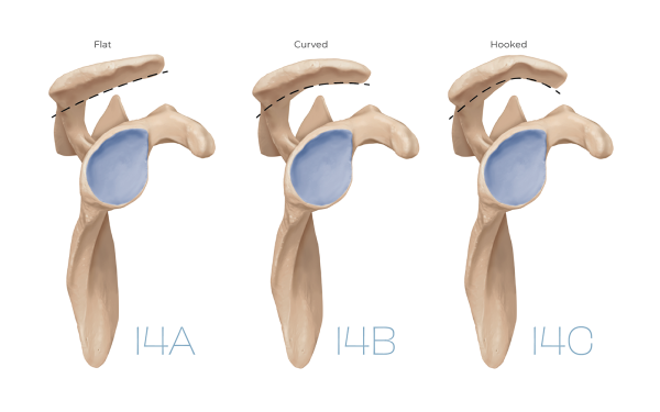 Shoulder Impingement Syndrome